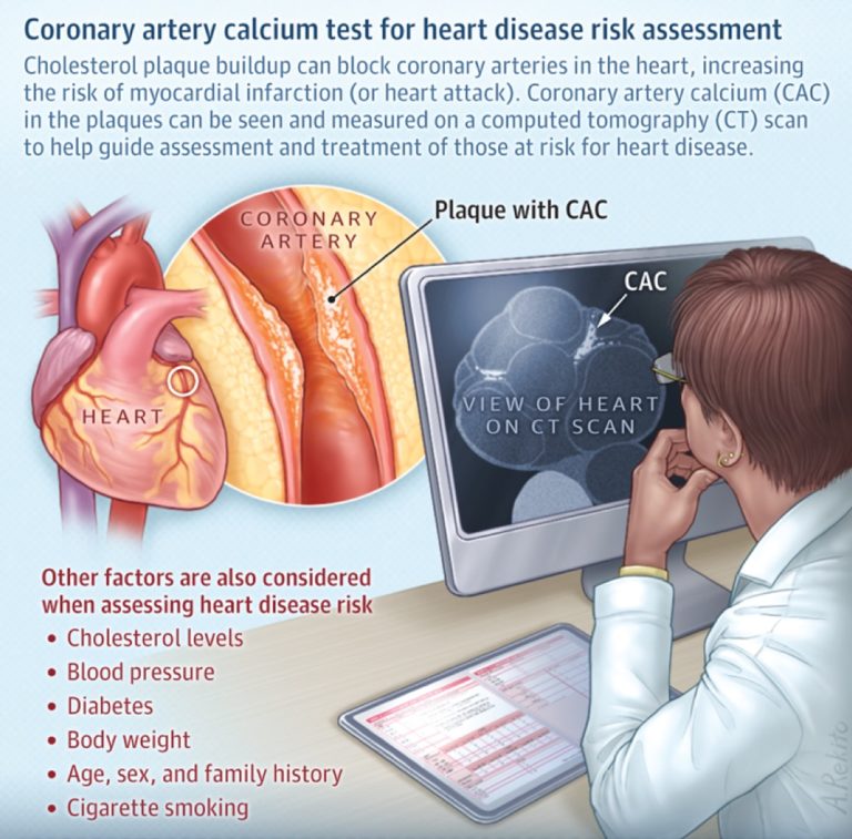 The Coronary Artery Calcium Scan (CACS) and Heart Disease - BioBalance ...